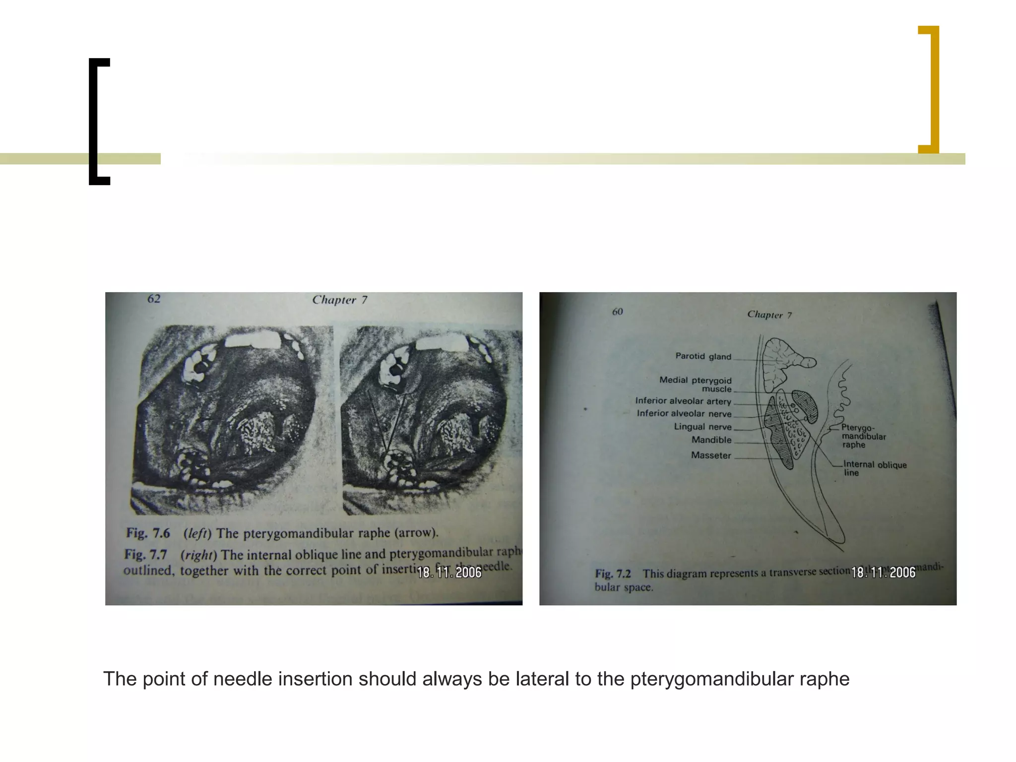 Local Anesthesia Injection Technique | PPT
