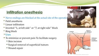 Local anesthesia Techniques in Surgery pptx | PPTX | Brain and Nervous ...