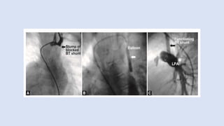 Late complications in tof and redo surgeries