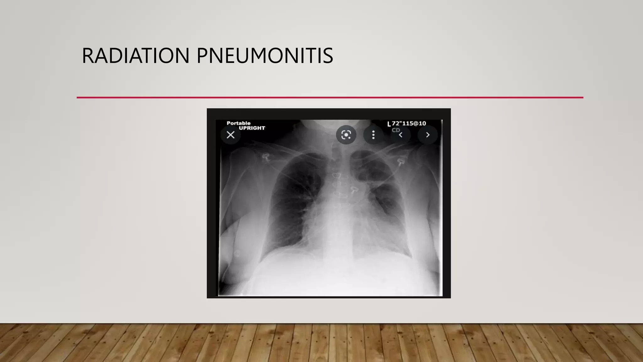 LATE EFFECTS OF RADIOTHERAPY.pptx