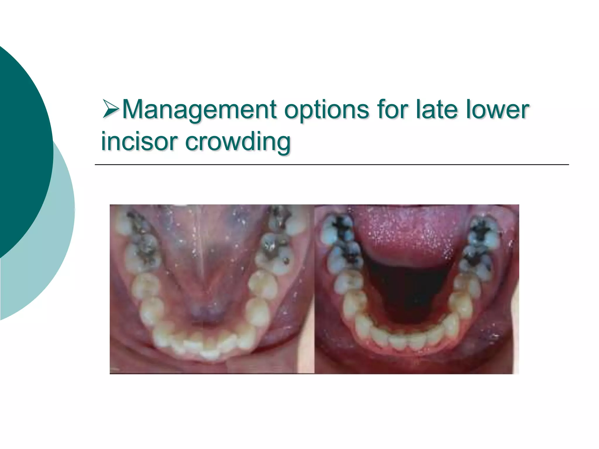 Late mandibular incisor crowding | PPT