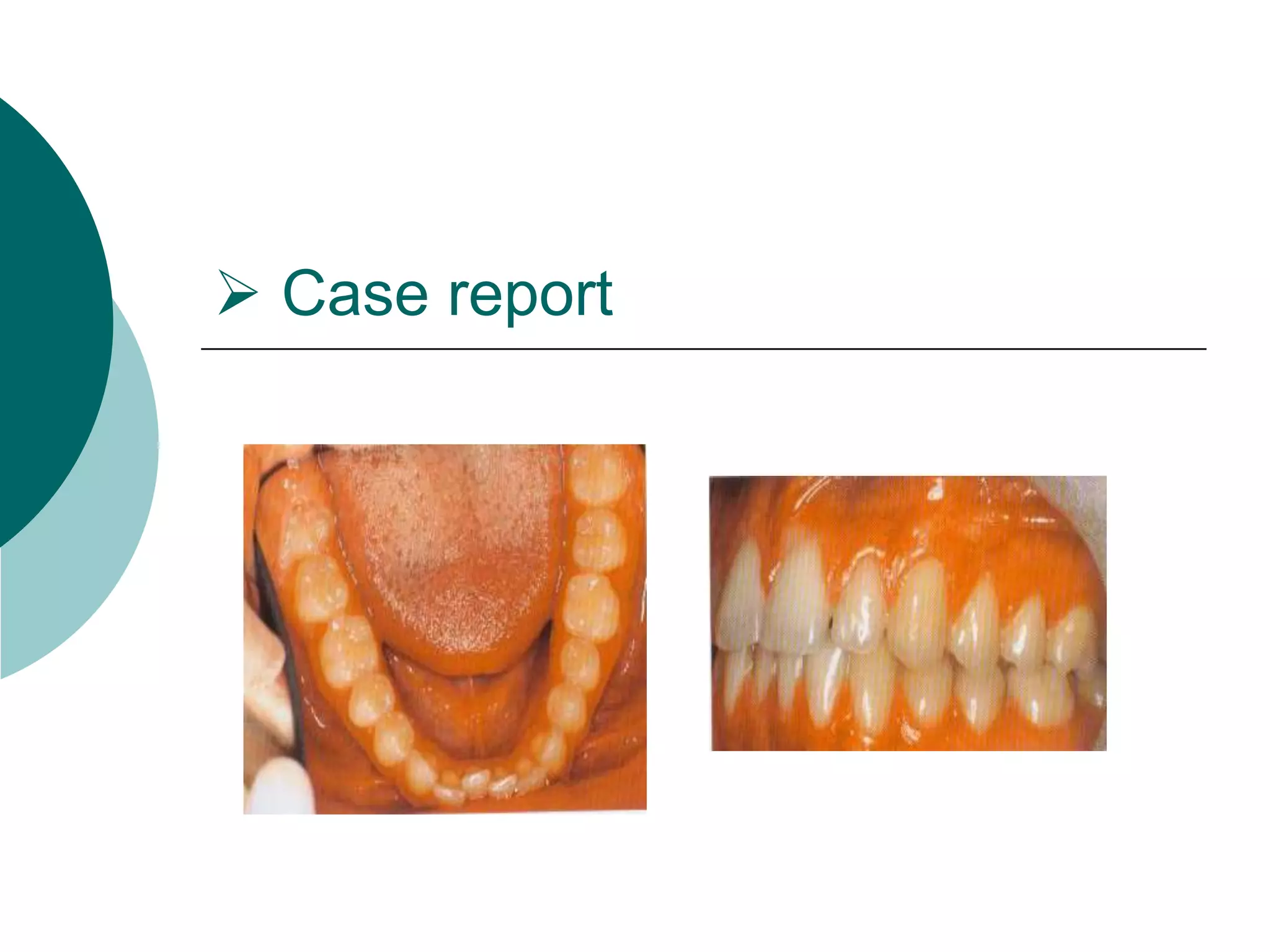 Late mandibular incisor crowding | PPT | Dental Health | Diseases and ...