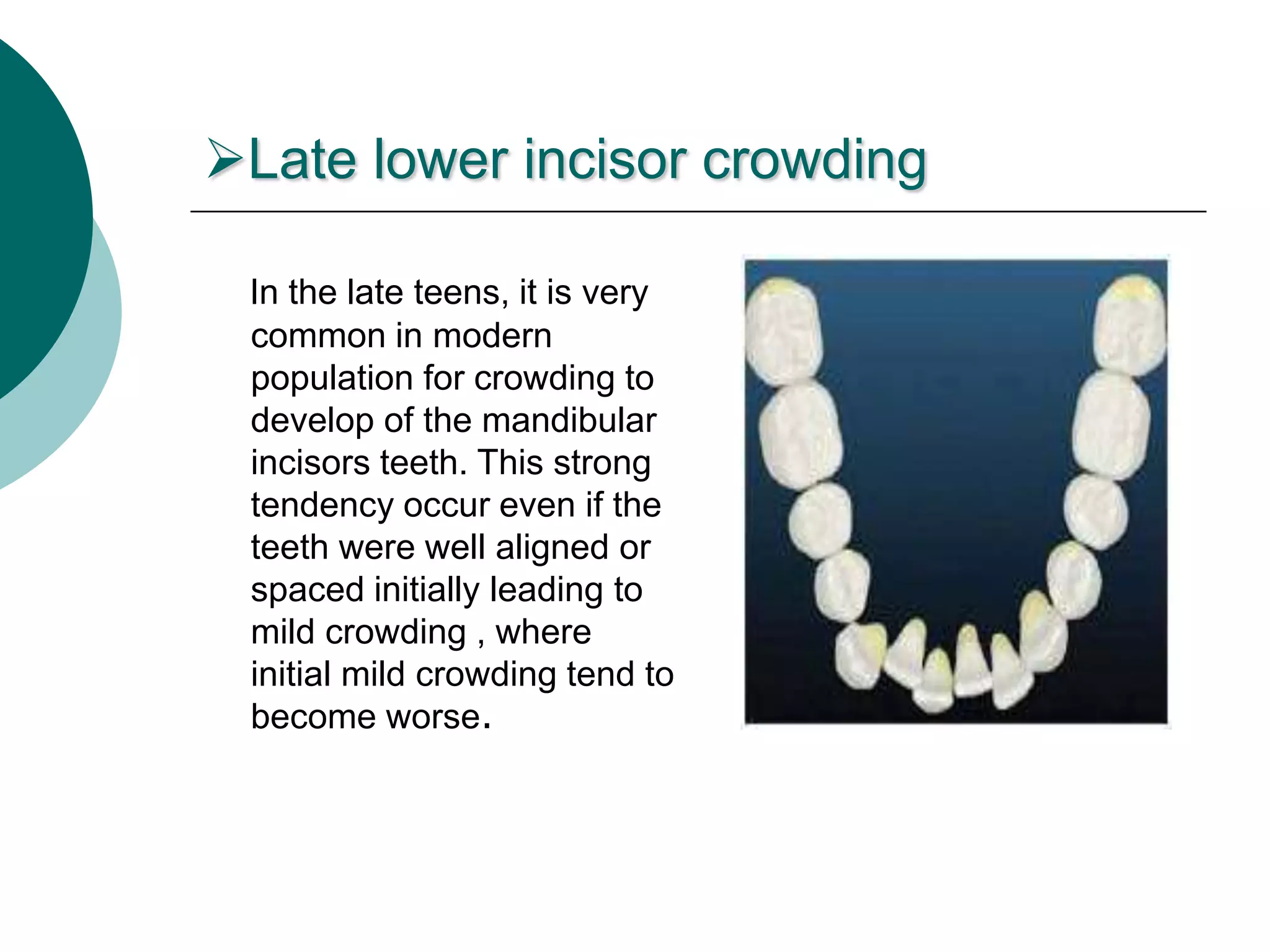 Late mandibular incisor crowding | PPT