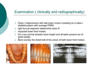 Late mandibular incisor crowding | PPT
