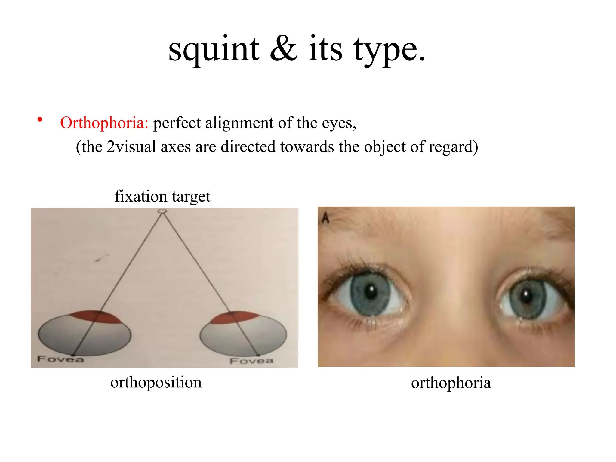 LATENT SQUINT.pptx (LATENT SQUINT,SQUINT) | PPTX