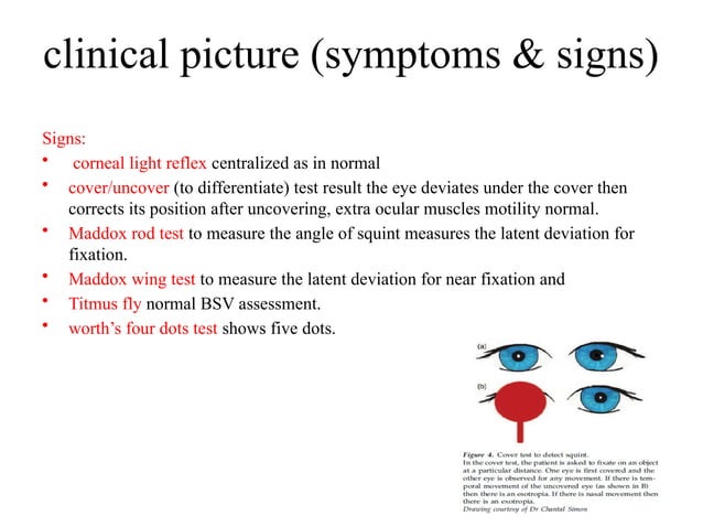 LATENT SQUINT.pptx (LATENT SQUINT,SQUINT) | PPTX | Eye and Vision ...