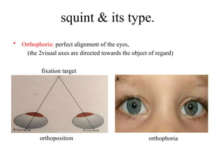LATENT SQUINT.pptx (LATENT SQUINT,SQUINT) | PPTX