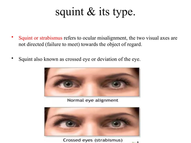 LATENT SQUINT.pptx (LATENT SQUINT,SQUINT) | PPTX | Eye and Vision ...