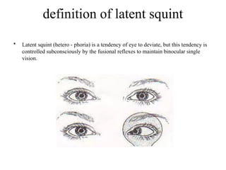 LATENT SQUINT.pptx (LATENT SQUINT,SQUINT) | PPTX