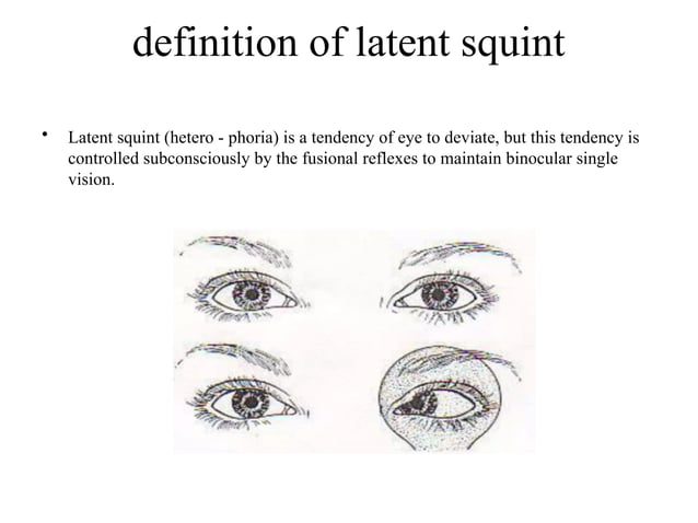 LATENT SQUINT.pptx (LATENT SQUINT,SQUINT) | PPTX | Eye and Vision ...
