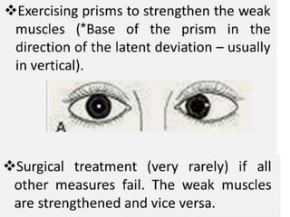 Latent and concomitant strabismus | PPT