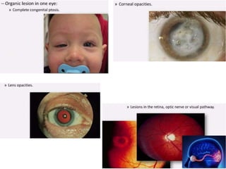 Latent and concomitant strabismus | PPT