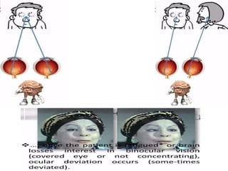 Latent and concomitant strabismus | PPT