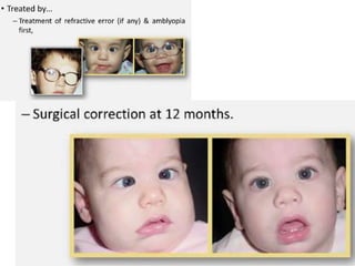 Latent and concomitant strabismus | PPT