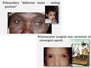 Latent and concomitant strabismus | PPT