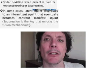 Latent and concomitant strabismus | PPT