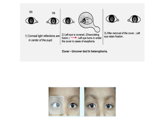 Latent and concomitant strabismus | PPT