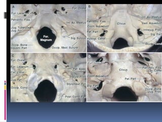 Late onset jugular foramen syndrome following head trauma | PPTX
