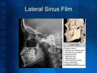 Lateral Sinus | PPT