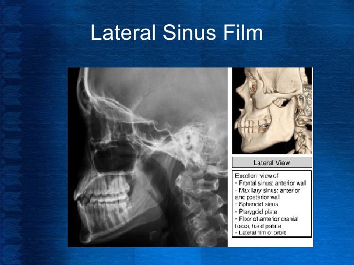 Lateral Sinus