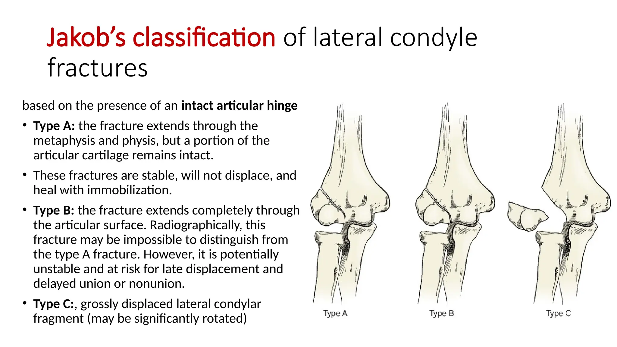 Lateral and Medial Humeral Condyle Fractures.pptx