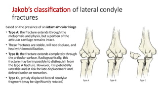Lateral and Medial Humeral Condyle Fractures.pptx