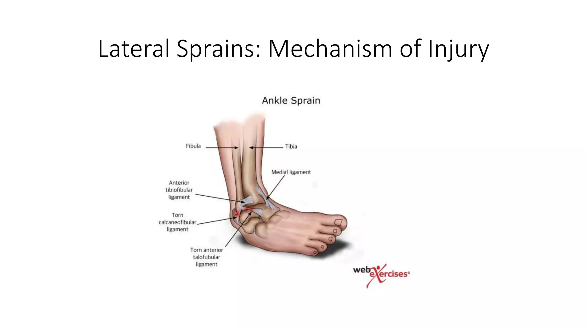 Lateral Ankle Sprain Presentation | PPTX