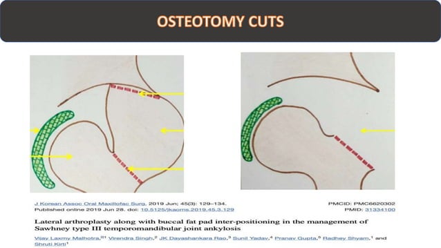 LATERAL ARTHROPLASTY PAPER.pptx
