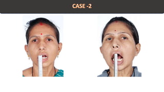 LATERAL ARTHROPLASTY PAPER.pptx