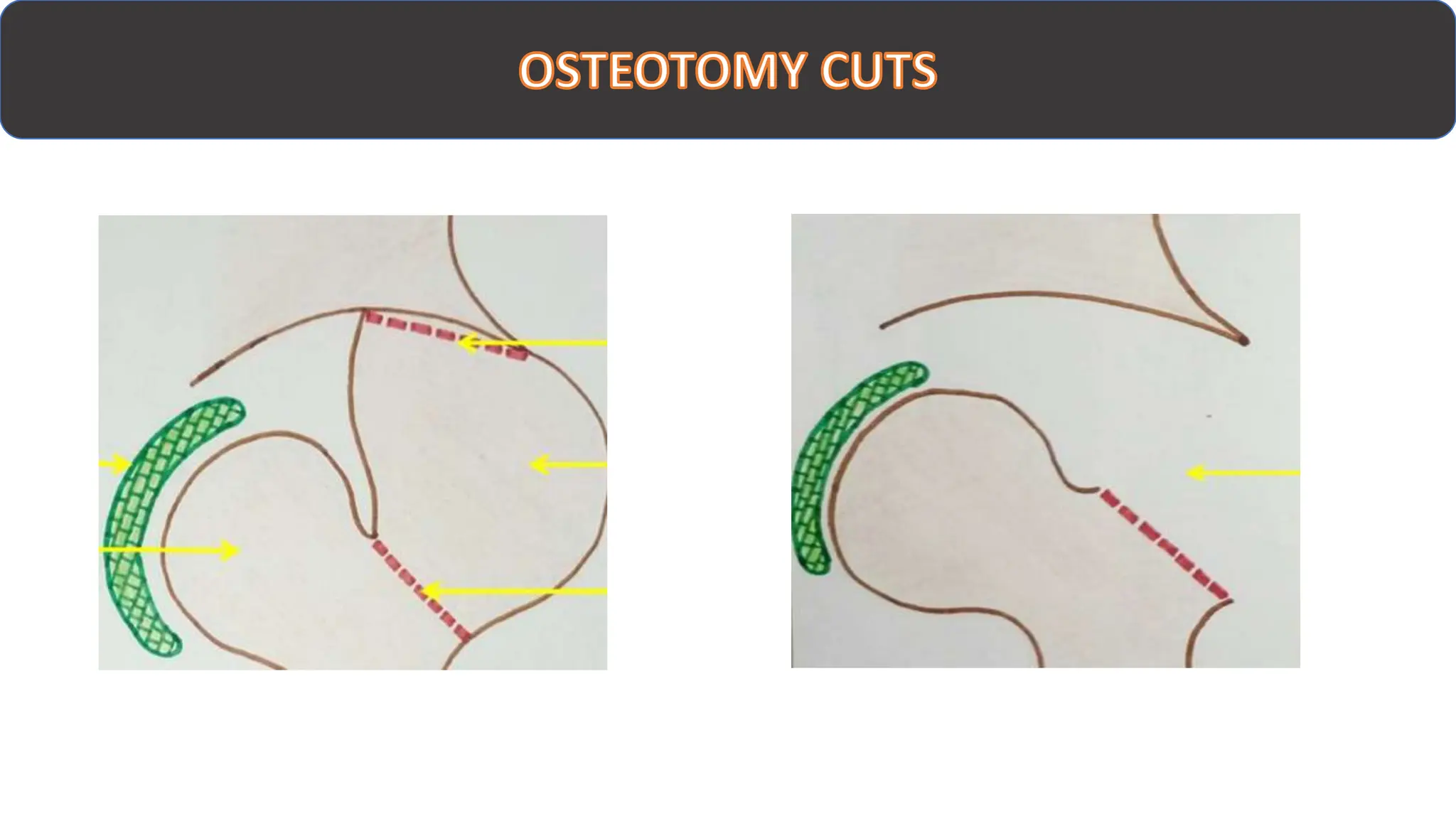 LATERAL ARTHROPLASTY in tmj ankylosis.pptx
