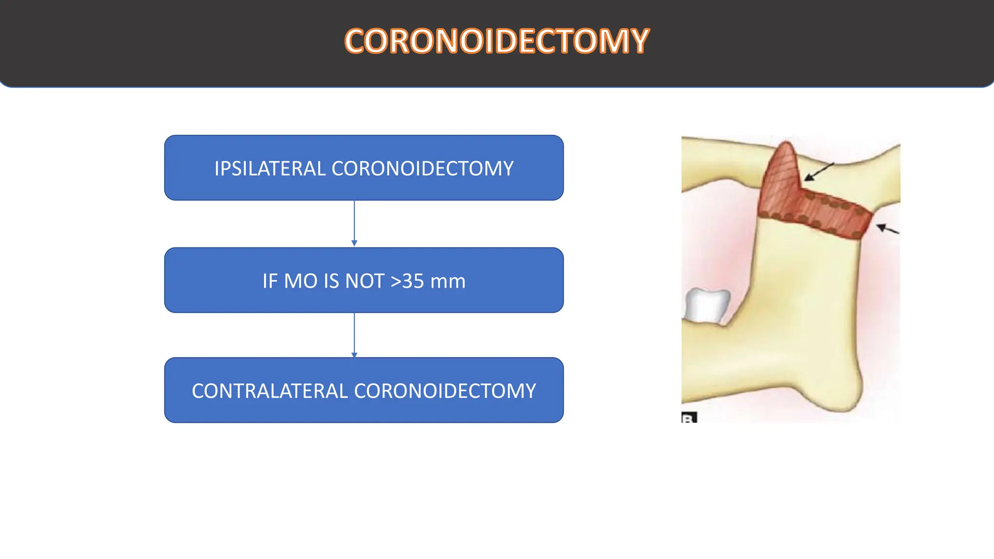 LATERAL ARTHROPLASTY in tmj ankylosis.pptx