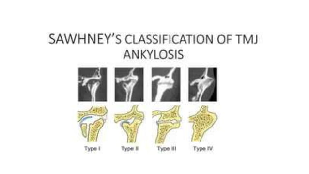 LATERAL ARTHROPLASTY in tmj ankylosis.pptx