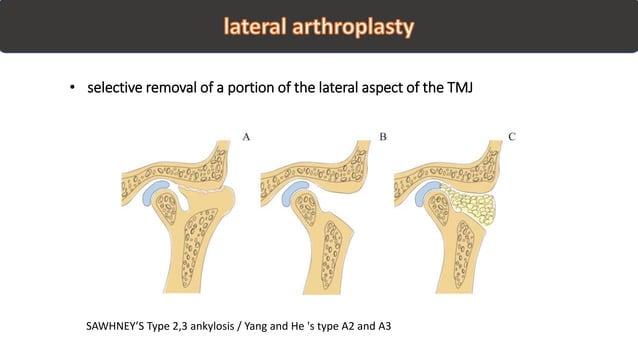LATERAL ARTHROPLASTY in tmj ankylosis.pptx