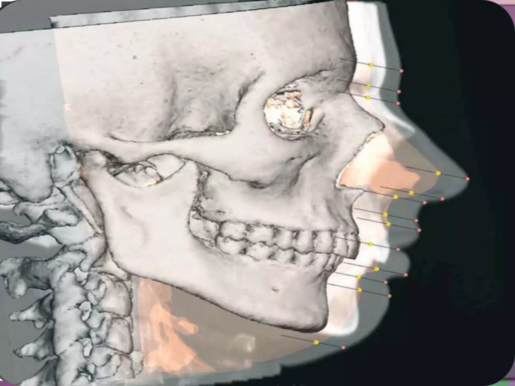 lateral cephalometric analysis in orthodontic | PPT