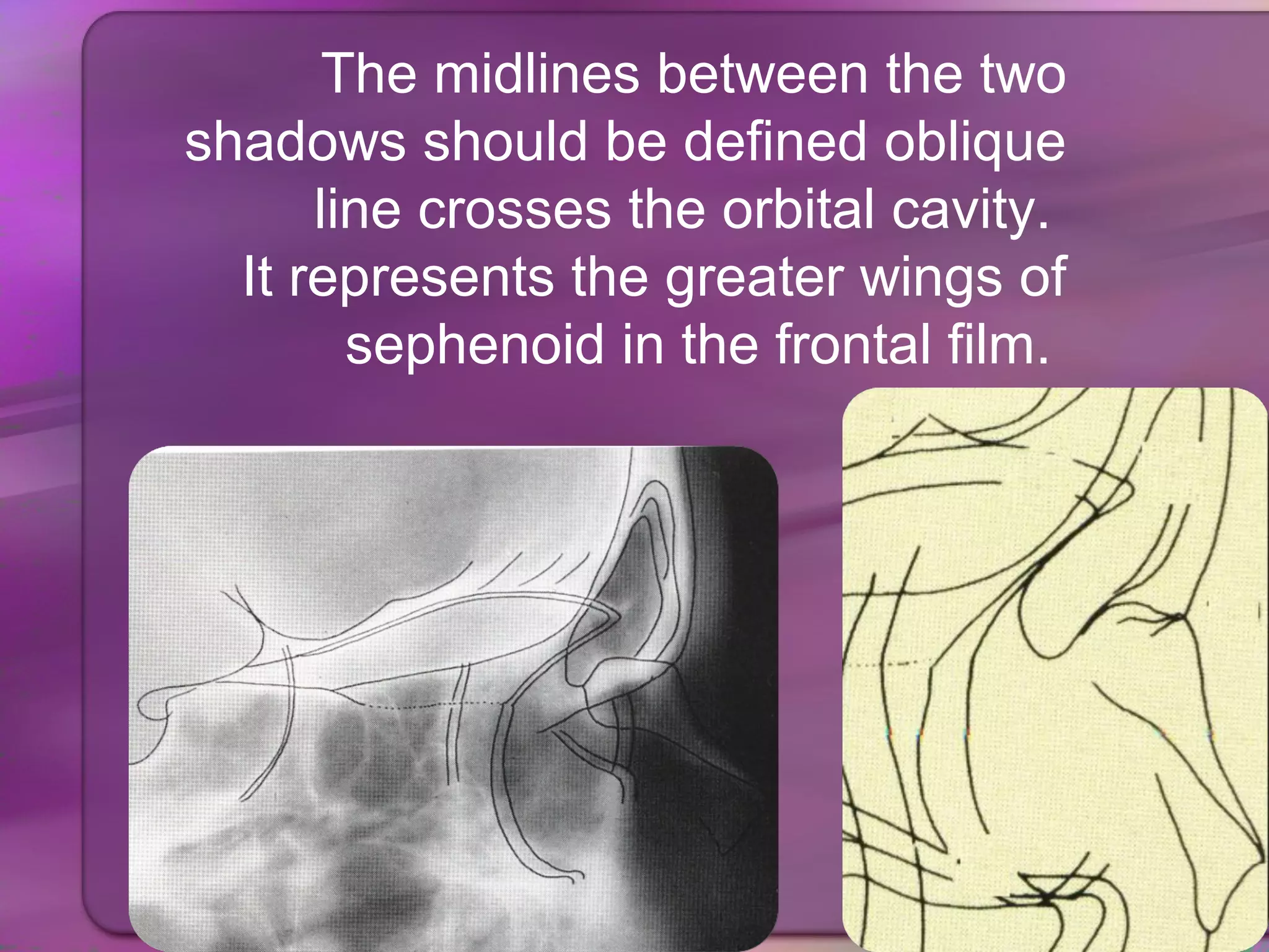 lateral cephalometric analysis in orthodontic | PPT