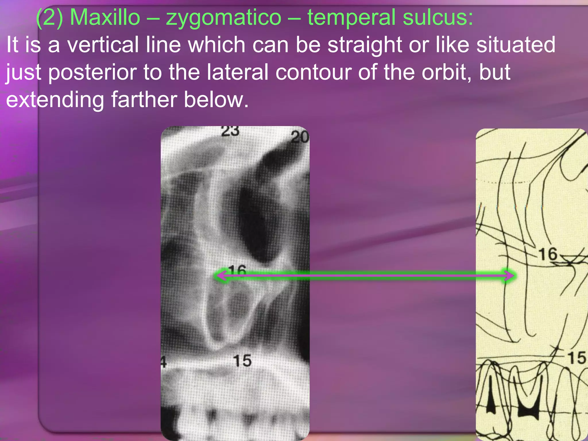 lateral cephalometric analysis in orthodontic | PPT