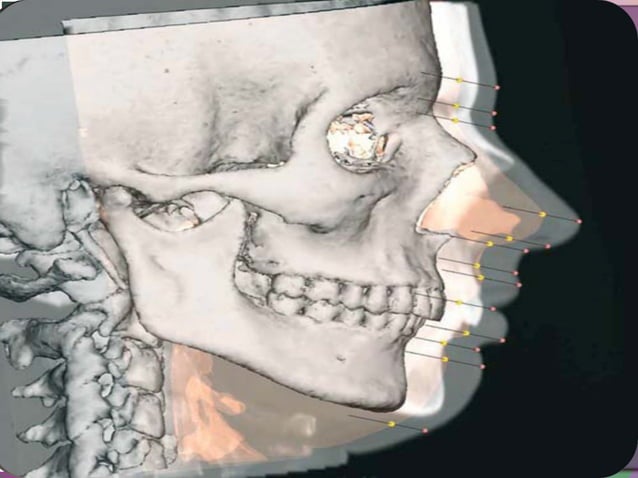 lateral cephalometric analysis in orthodontic | PPT