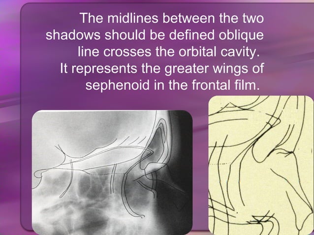 lateral cephalometric analysis in orthodontic | PPT