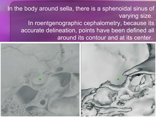 Planum Sphenoidale Lateral Ceph