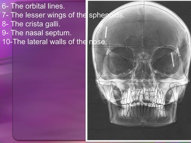 lateral cephalometric analysis in orthodontic | PPT