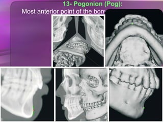 lateral cephalometric analysis in orthodontic | PPT