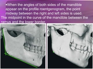 lateral cephalometric analysis in orthodontic | PPT