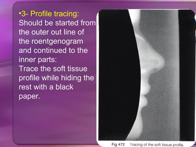 lateral cephalometric analysis in orthodontic | PPT