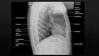 Lateral chest X-Ray.pptx
