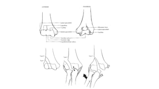 Lateral Condylar Fracture of the Humerus | PPTX