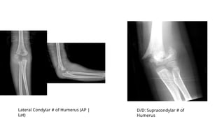 Lateral Condylar Fracture of the Humerus | PPTX
