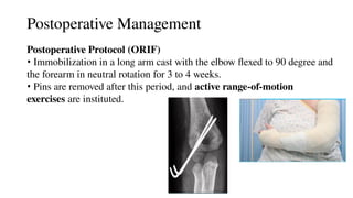 Lateral Condylar Fracture of the Humerus | PPTX