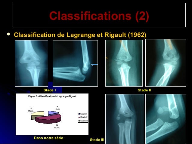 Lateral condylar fracture of humerus in children