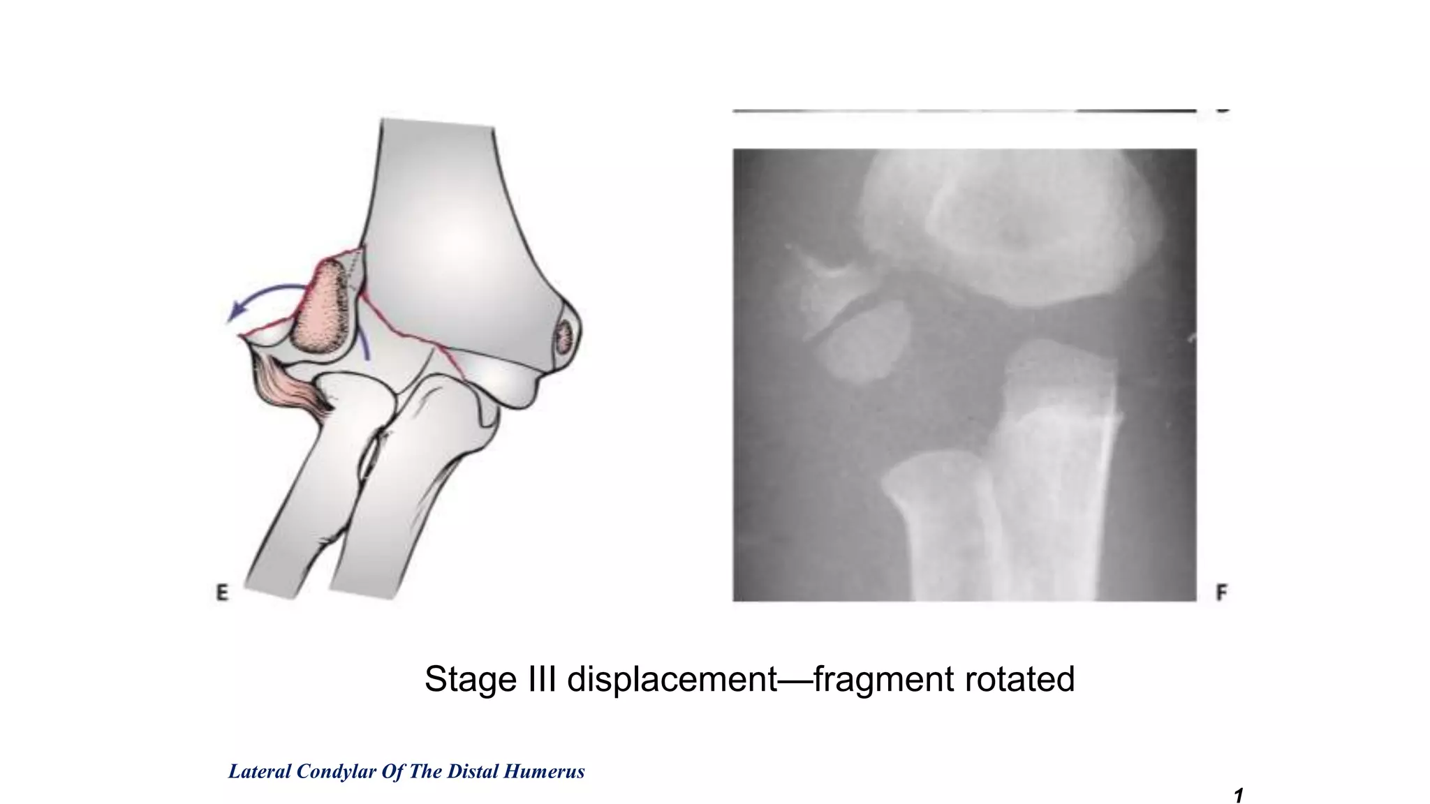 Lateral condylar fractures of the distal humerus | PPTX