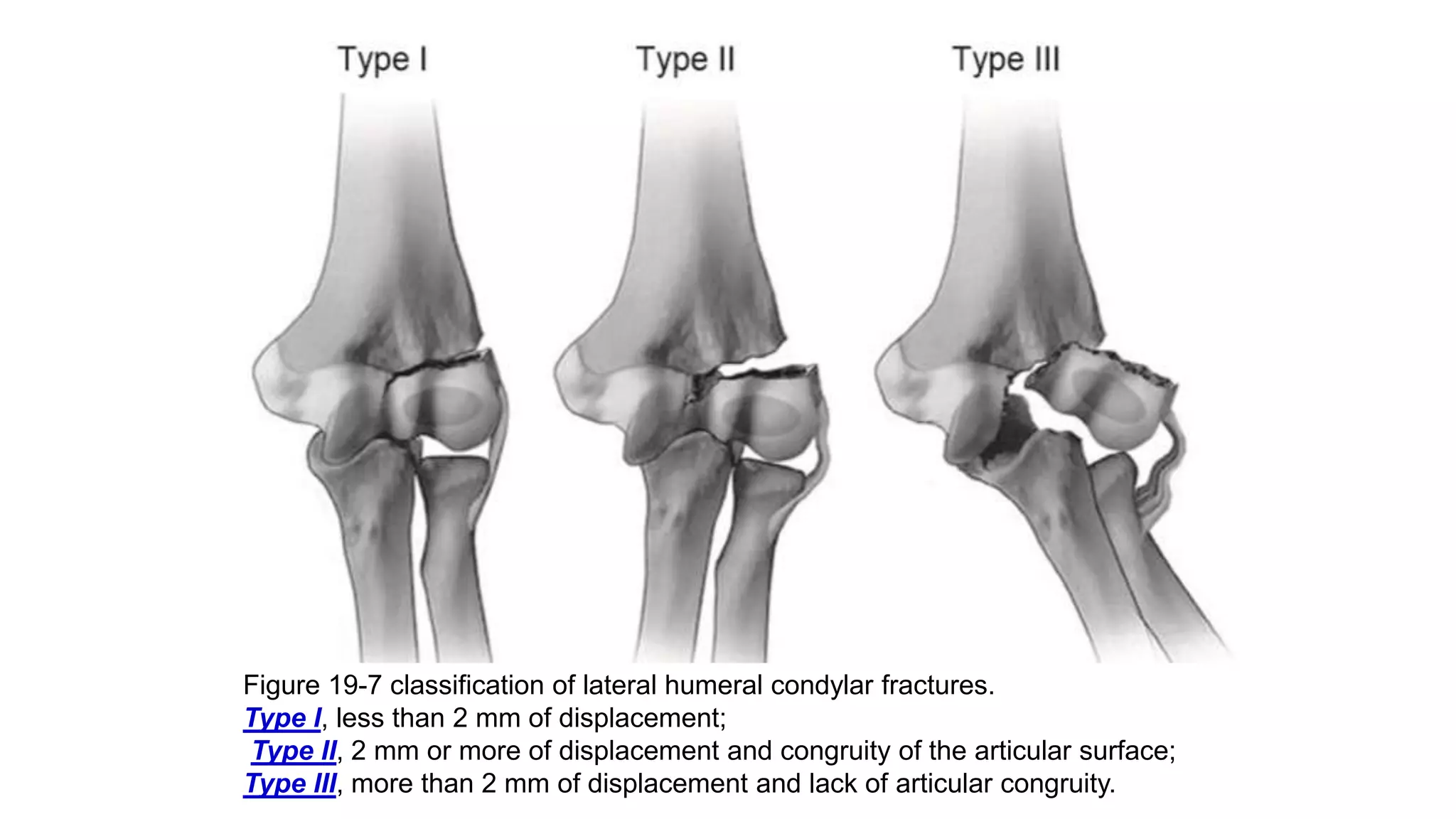 Lateral condylar fractures of the distal humerus | PPTX